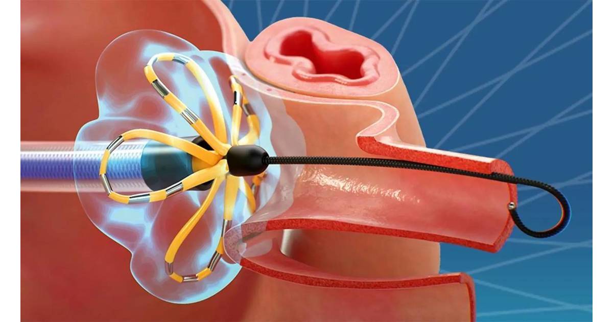 St Lukes First To Offer New Pulsed Field Ablation For Atrial