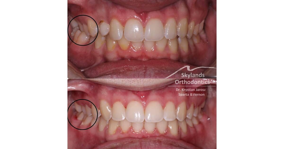 Crossbite Correction for Lasting Confidence and Health!! | Sparta, NJ ...