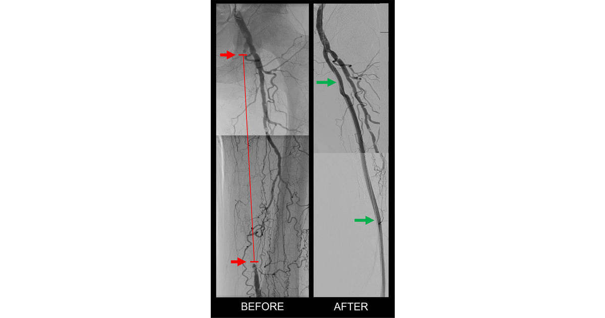 St. Luke’s Vascular Surgeons Pioneer New Incisionless Bypass Treatment for Blocked Leg Arteries ...