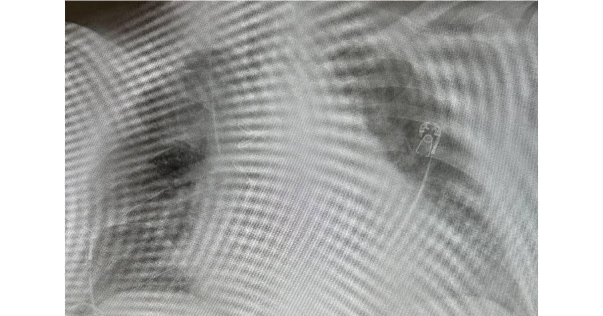 Deconditioning and the Flabby Heart | Bridgewater/Raritan, NJ News TAPinto